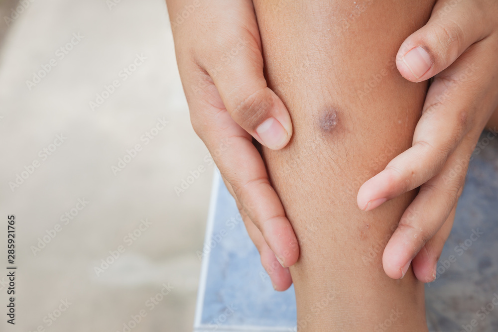 Boy having cover of dried blood or scab on knee. Bright bruise damage ...