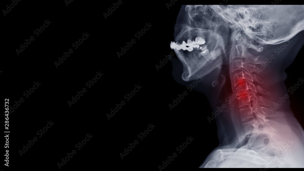 Film x-ray spine radiograph show cervical spondylosis which is spinal ...