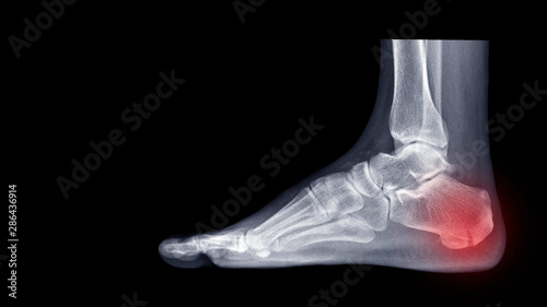 Calcaneus Bone X Ray