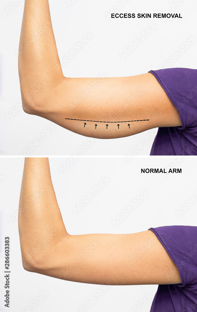arm with excess skin and arm with normal skin, Before and after under ...