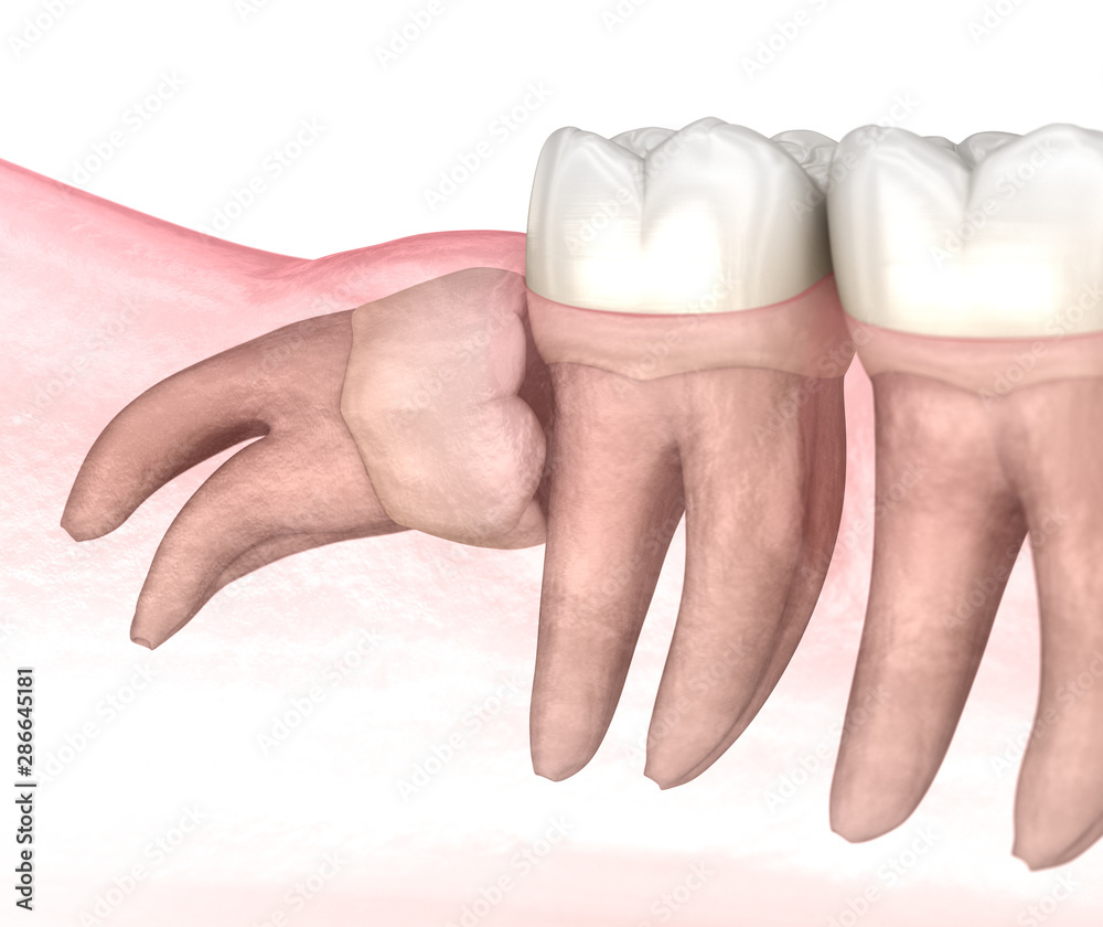 Horizontal impaction of Wisdom tooth. Medically accurate tooth 3D ...