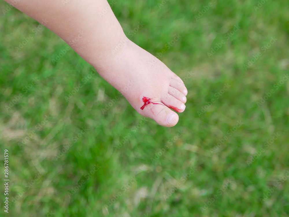 the child injured his leg. The girl provides first aid to her child ...