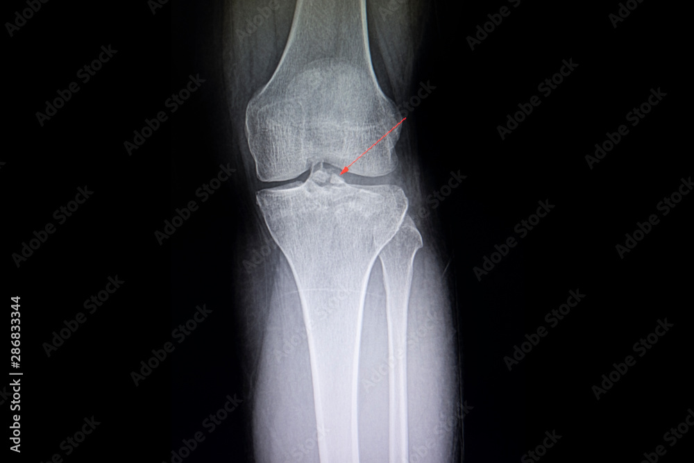fracture tibial spine film Stock Photo | Adobe Stock