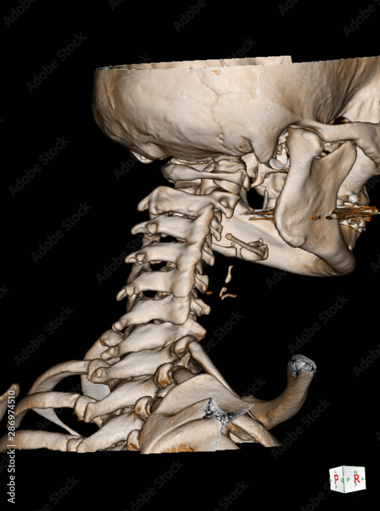 CT Scan cervical spine 3 D render and X-ray C-spine finding Reverse ...