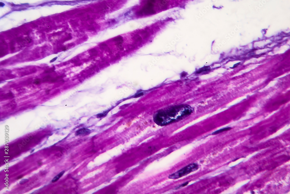 Heart hypertrophy, histopathology. Photomicrograph showing hypertrophic ...