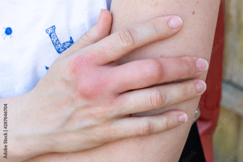 right women hand after a bee, wasp bite, swollen hand lyes on right arm ...