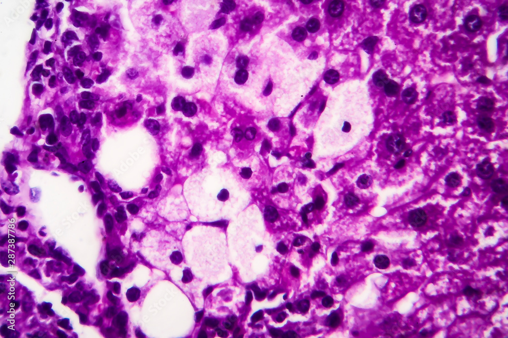 Histopathology of acute hepatitis, light micrograph, photo under ...