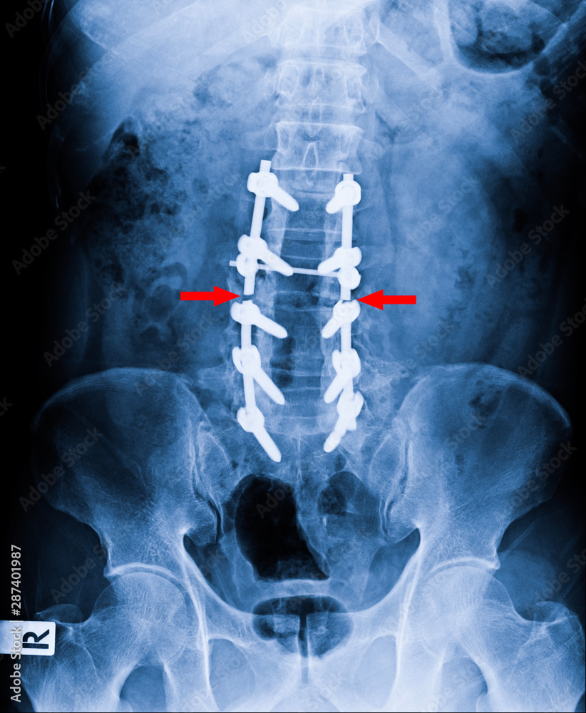 Rod fracture after posterior correction of adult spinal deformity with ...