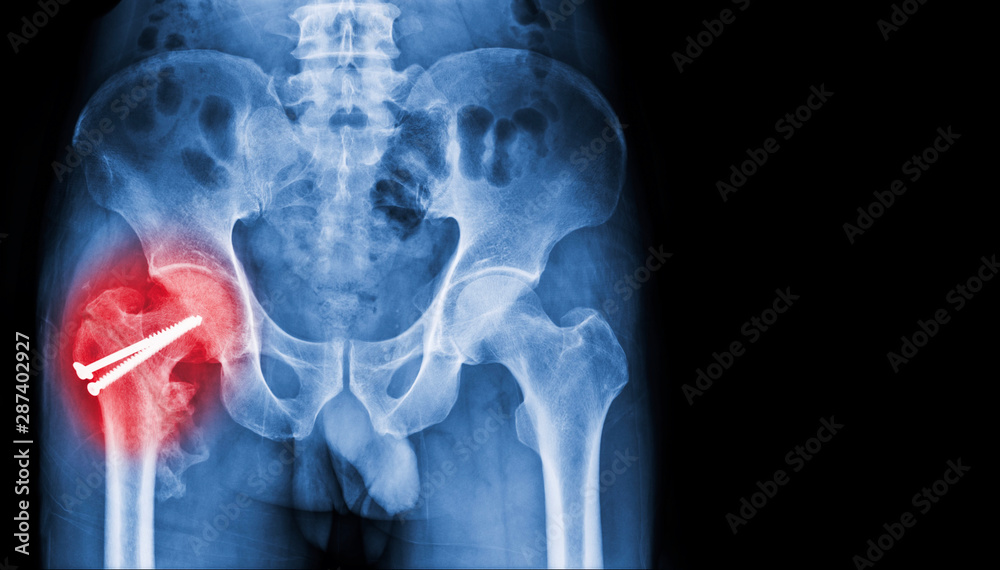 Hip fracture Repair. Shown is a fracture of the femoral neck that was ...