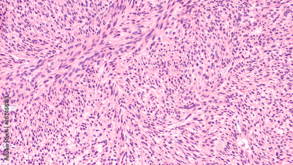 Microscopic image of a leiomyosarcoma, a type of soft tissue sarcoma of ...