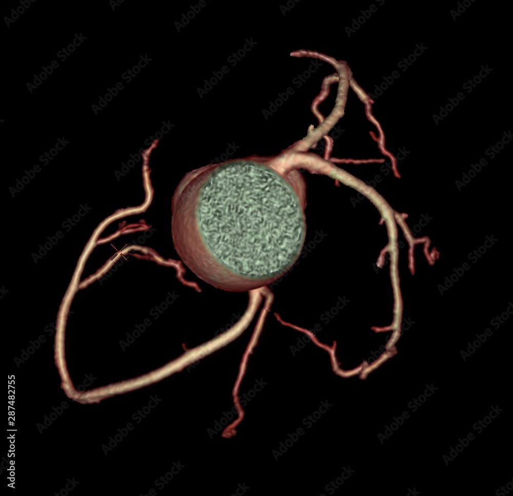3D SCAN CTA Coronary artery, coronary tree Stock Illustration | Adobe Stock