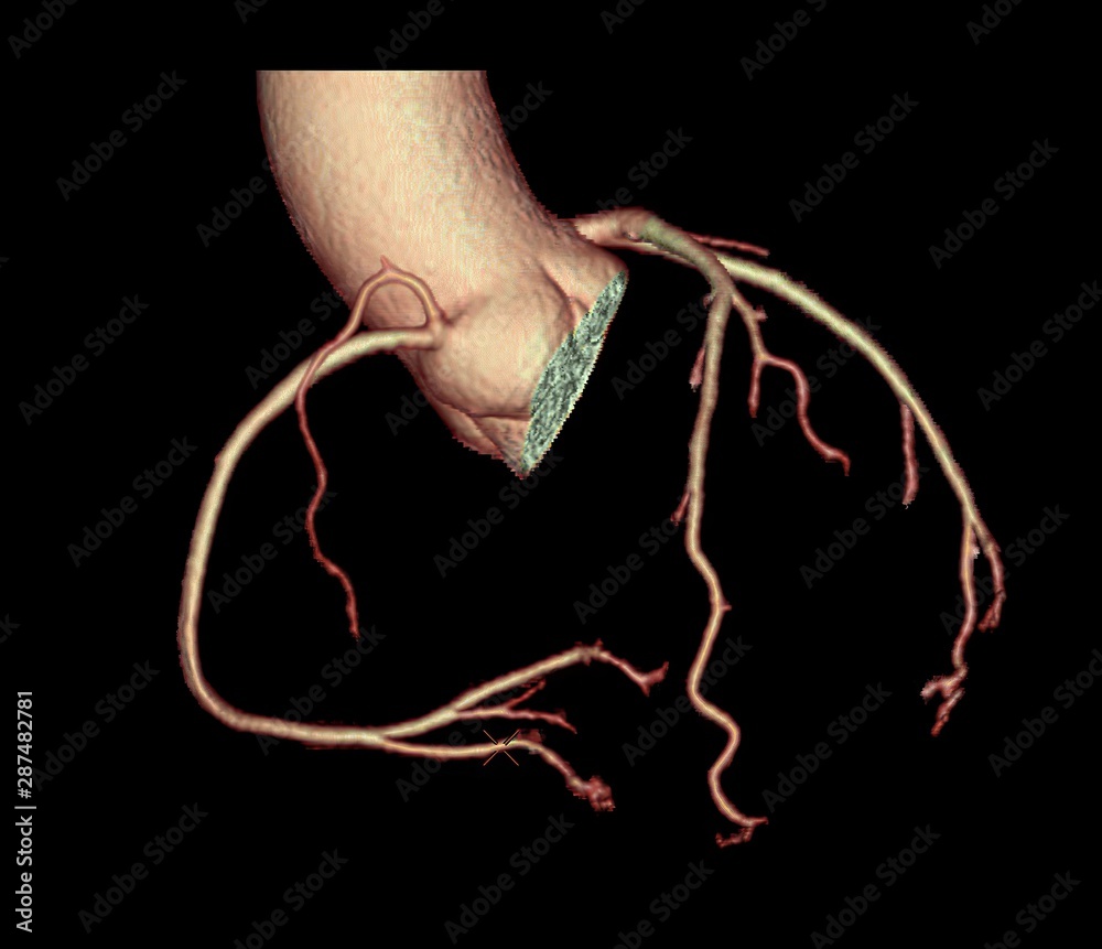 3D SCAN CTA Coronary artery, coronary tree Stock Illustration | Adobe Stock