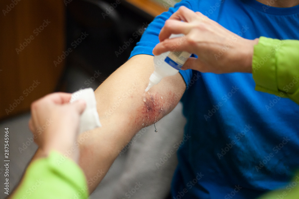 Sports injury. First aid A wound on the arm. A bruise is treated with ...