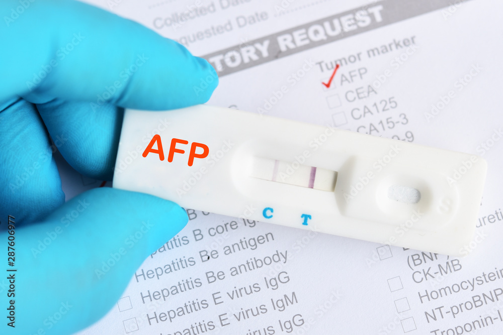 AFP positive test result by using rapid test cassette, liver cancer ...