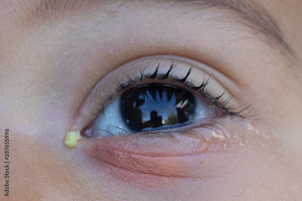A closeup view on the red and sore eye of a young kid, with ...