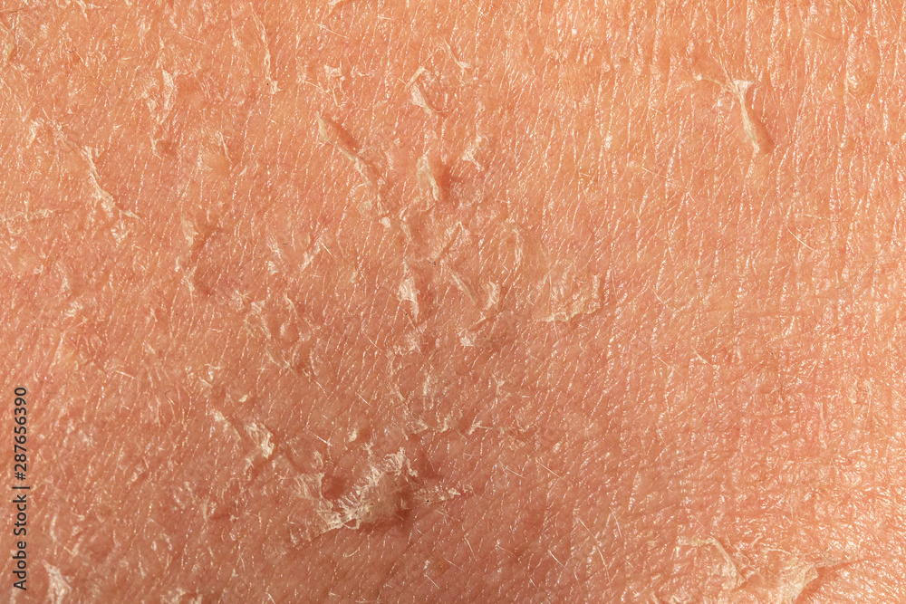 Peeling and flaking skin of a middle aged person is seen close-up ...