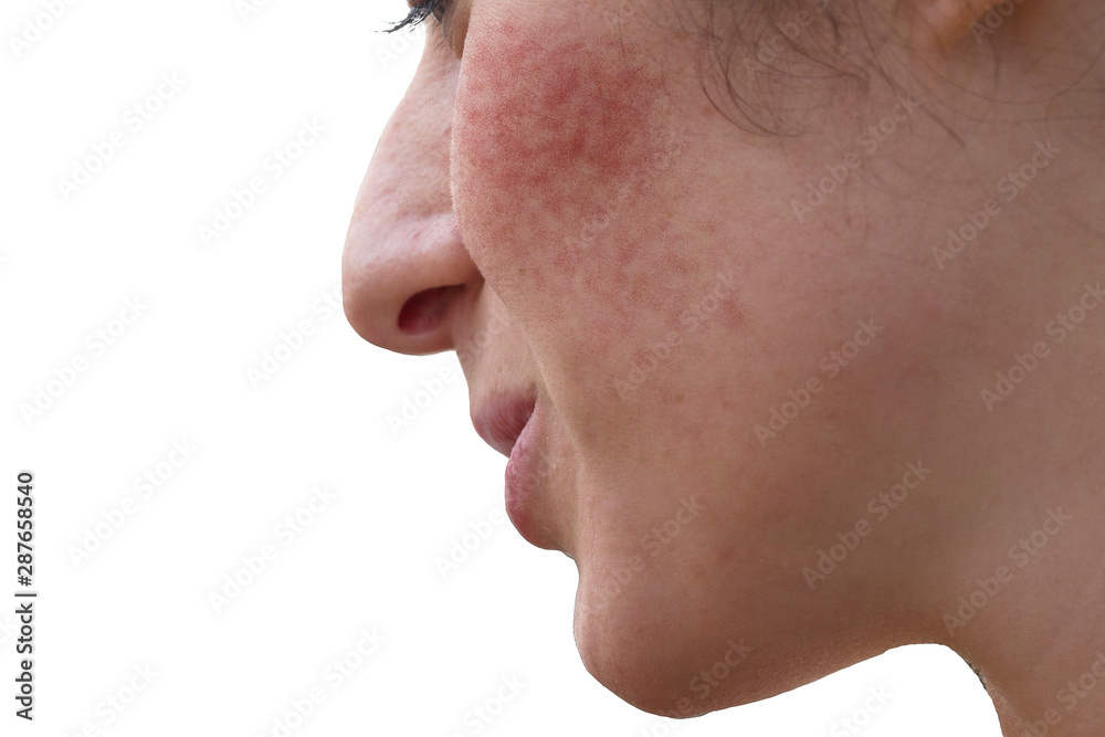 Foto Stock A low angle and side view on the cheek of a caucasian girl ...