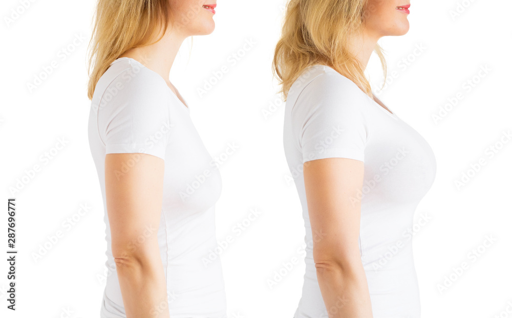 Woman before and after breast augmentation plastic surgery Photos ...