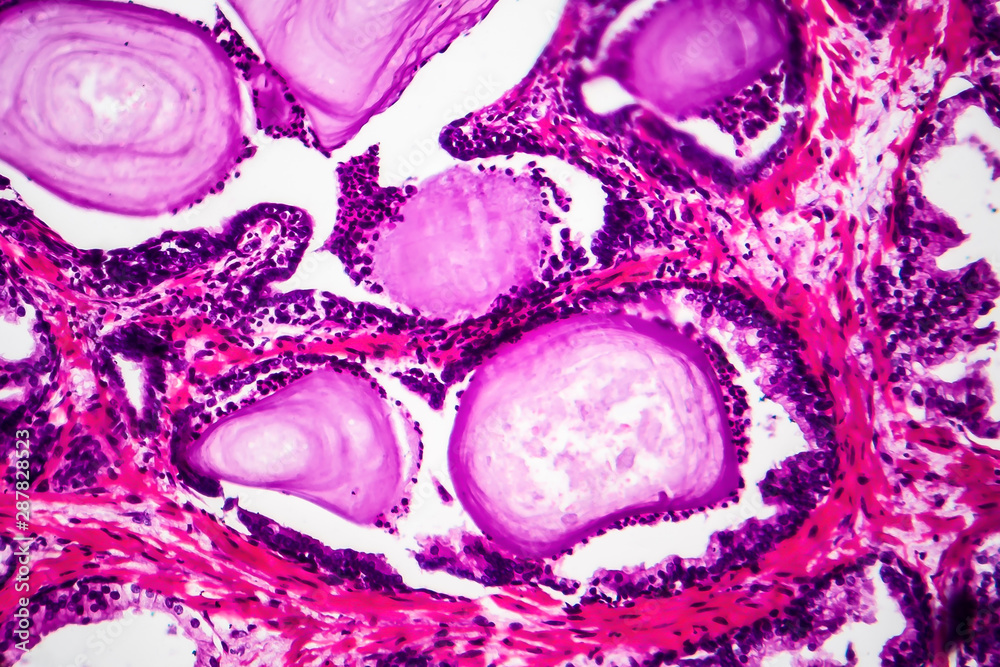 Benign prostatic hyperplasia, light micrograph, photo under microscope ...