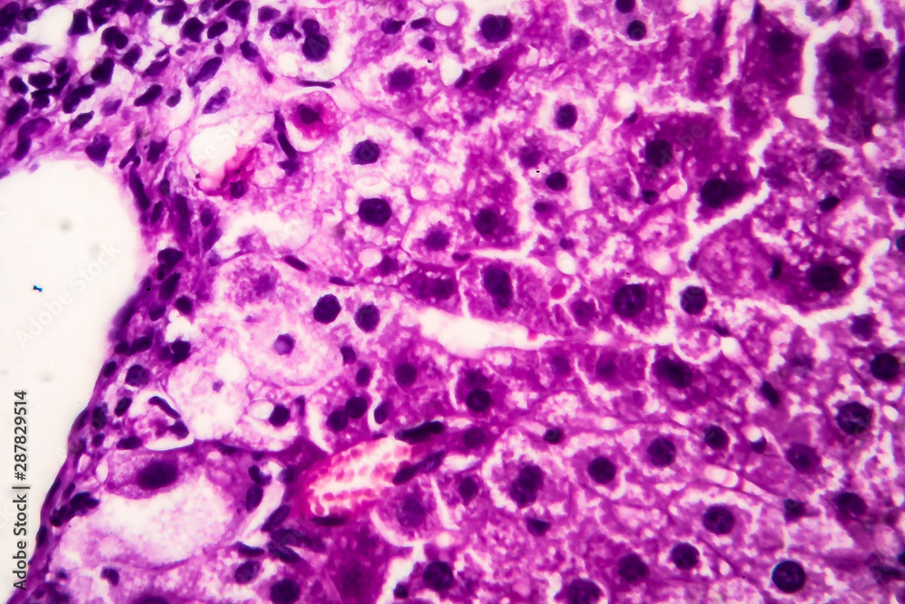 Histopathology of acute hepatitis, light micrograph, photo under ...