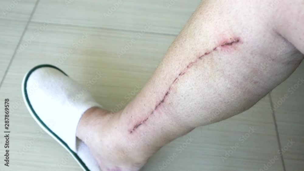 Selective focus of old male human leg with scar from cardiac surgery of ...