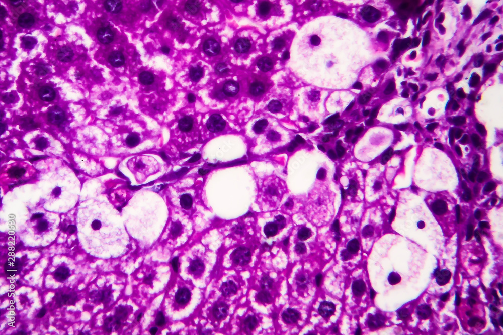 Histopathology of acute hepatitis, light micrograph, photo under ...