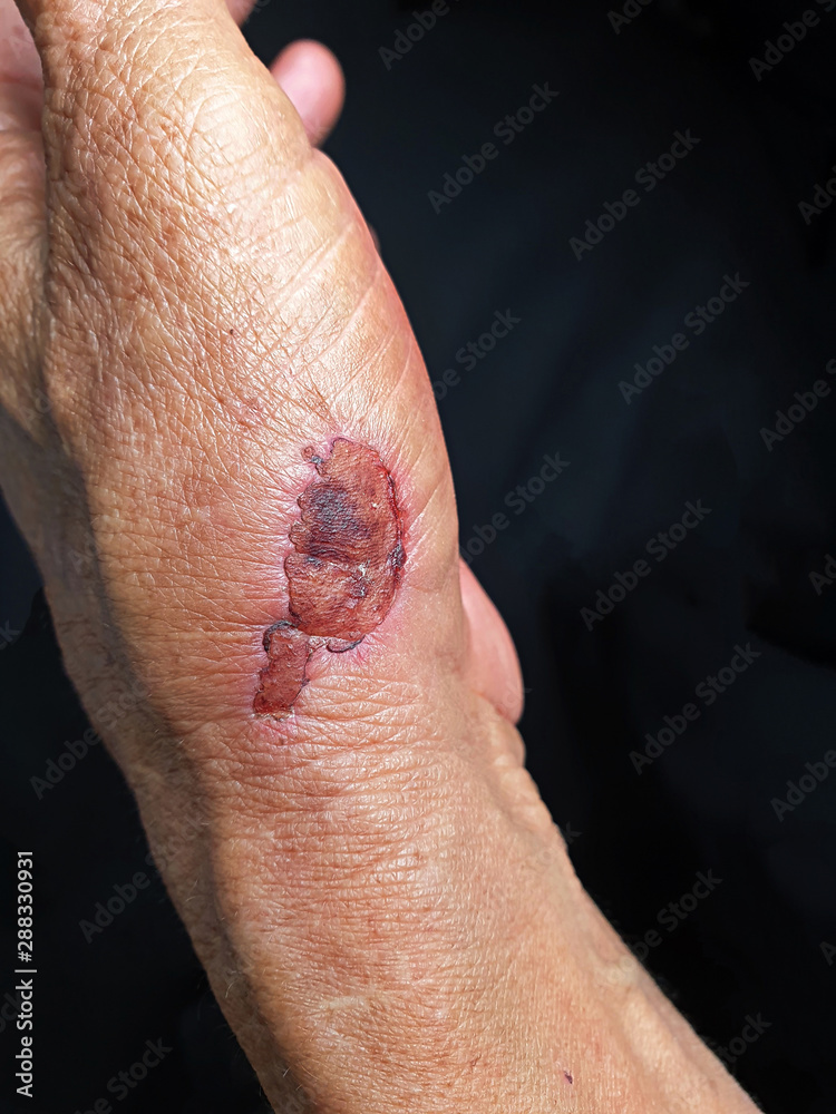 Texture of lesions skin caused by accident. Stock Photo | Adobe Stock