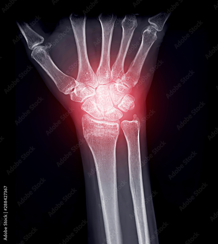 Arthritis In Wrist Diagnosis at Jasper Vogel blog