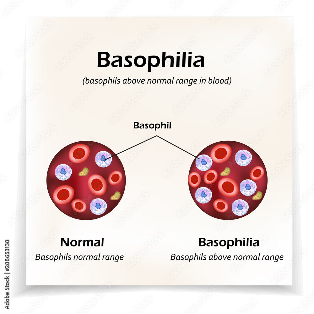 Basophils above the normal range in the blood. Basophilia. Infographics ...