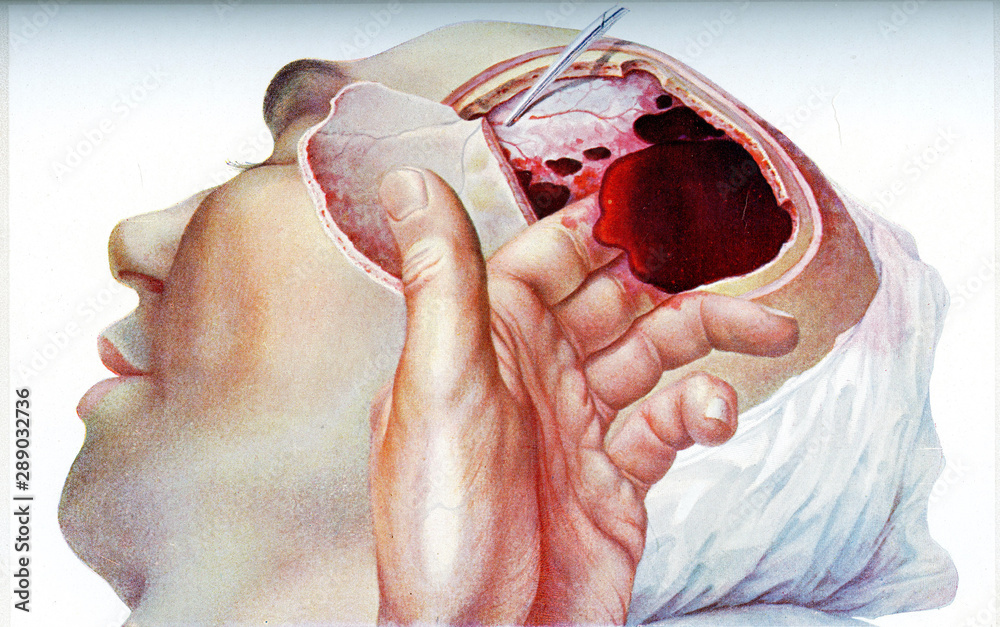 Intercranial hematome.Surgical treatment of the intracranial hemorrhage ...