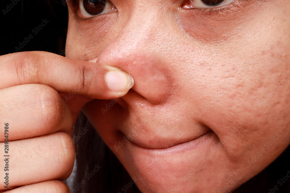 Woman pointing finger at blackhead acne from face, Problems with acne ...