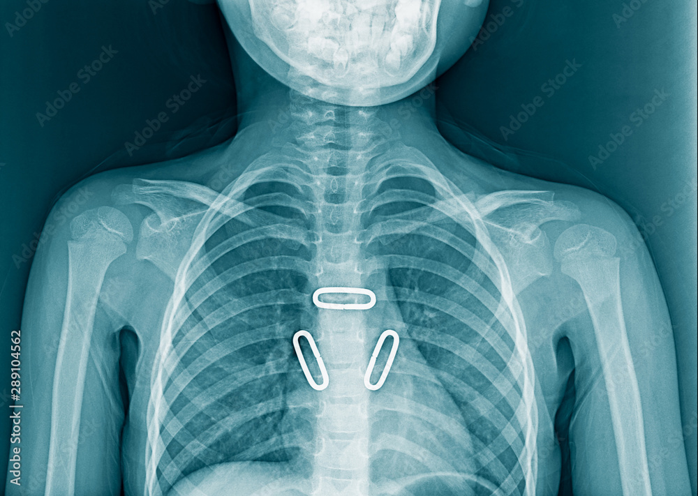 kid chest x-ray image in blue tone Stock Photo | Adobe Stock
