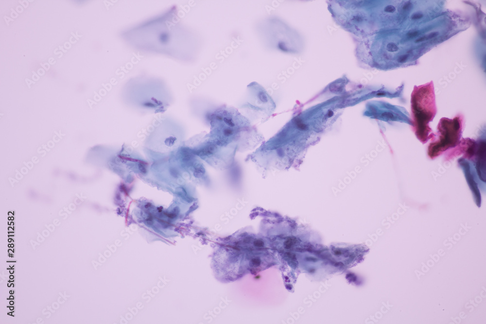 View in microscopic of Candidiasis, fungus infection (Yeast and ...