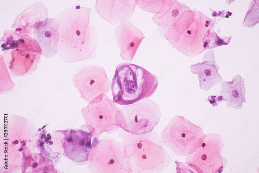 View in microscopic of abnormal human cervix cells.Koilocyte cell ...