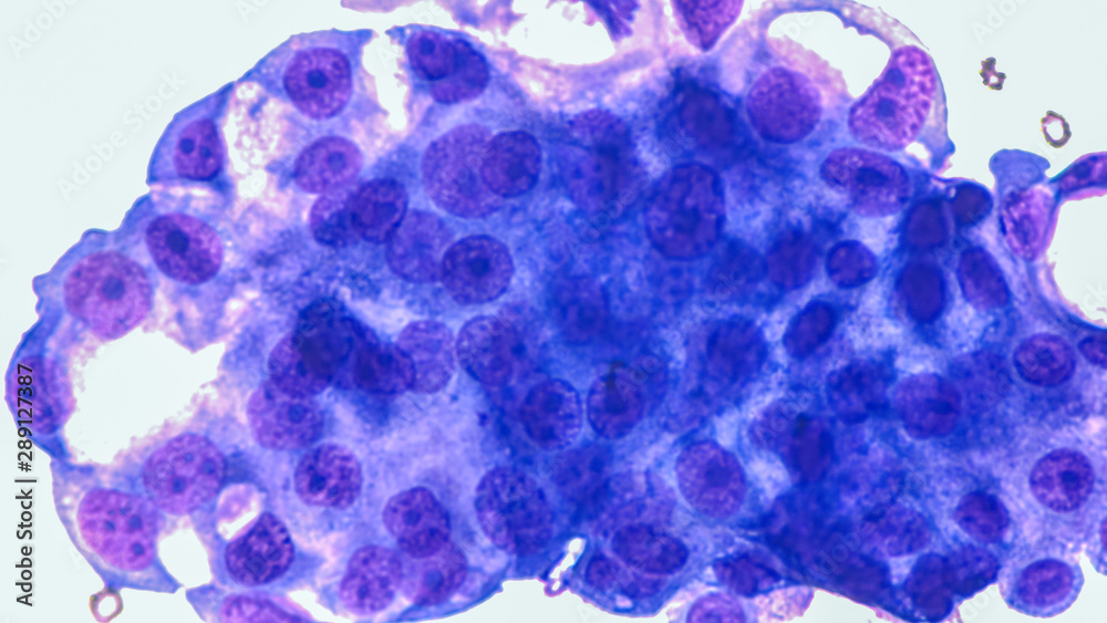 Fluid cytology showing adenocarcinoma, type of cancer. Stock Photo ...