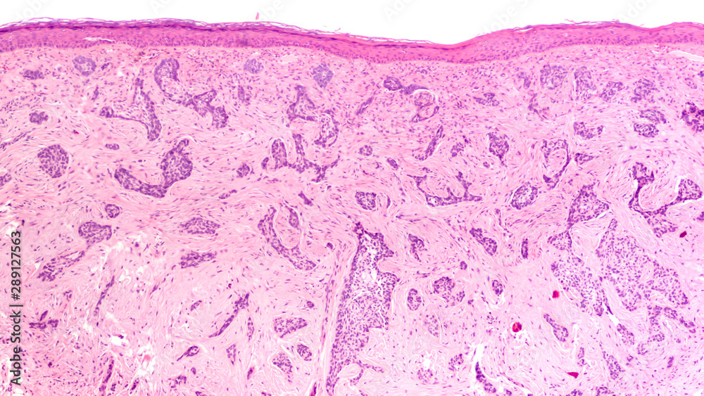 Morpheaform Basal Cell Carcinoma Histology