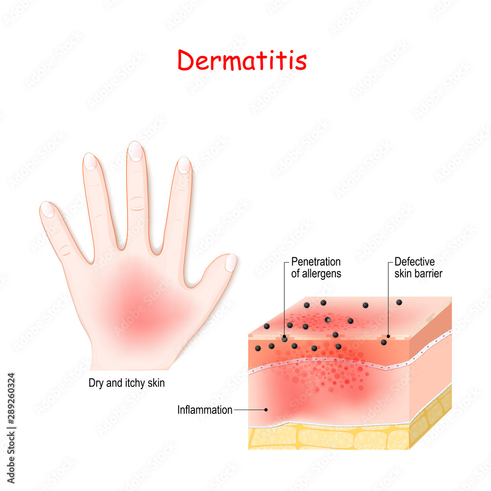 Dermatitis Atopic Eczema Close Up Of Cross Section Of Human Skin With