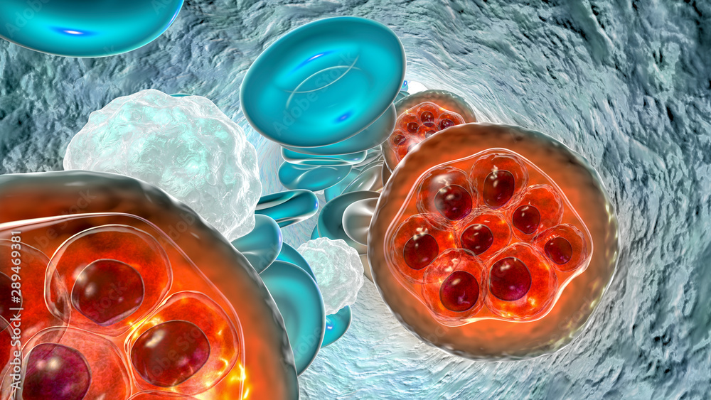Malaria infection, 3D illustration. Plasmodium parasites inside red ...