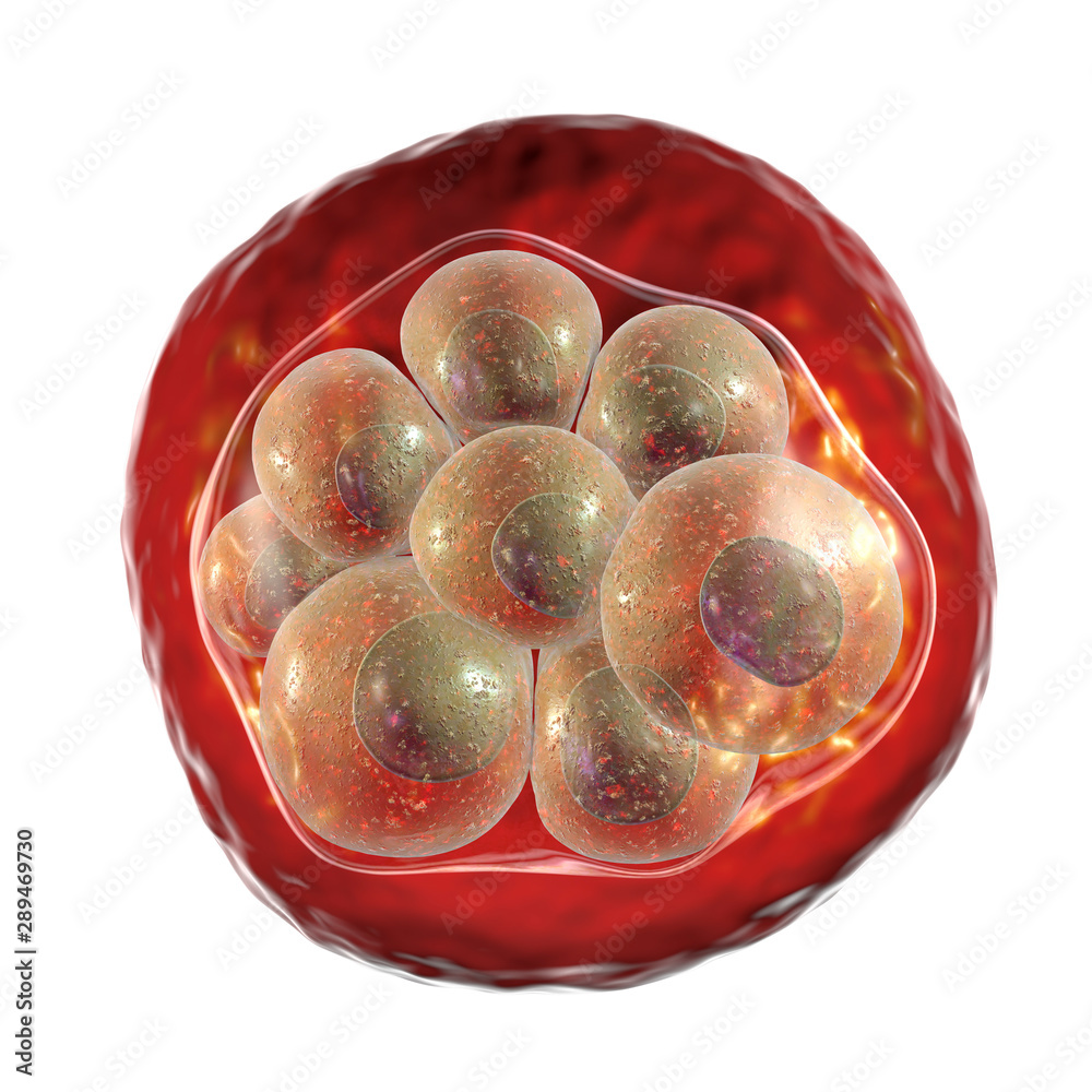 Red blood cell infected with malaria parasite, 3D illustration showing ...