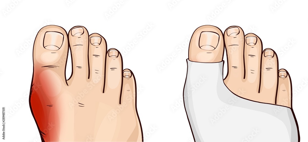 Hallux valgus is the commonest forefoot deformity Stock Illustration ...