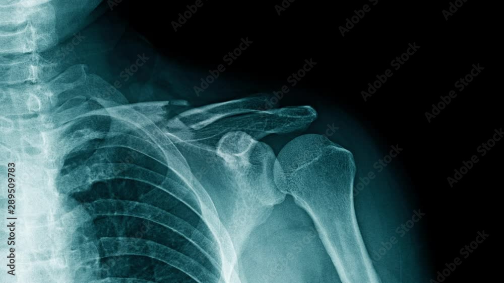 shoulder pain x-ray footage with red hight light on shoulder joint ...