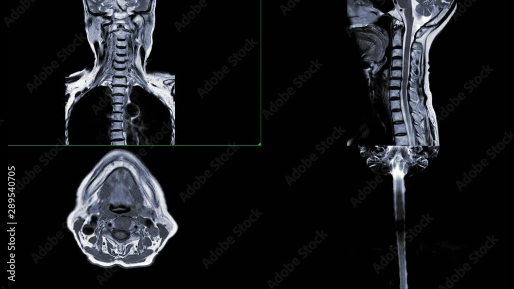 MRI of cervical spine coronal, sagittal, axial view and MRI myelogram on sagittal plane for ...