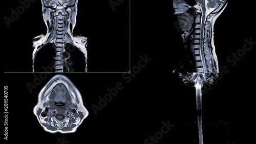 MRI of cervical spine coronal, sagittal, axial view and MRI myelogram ...