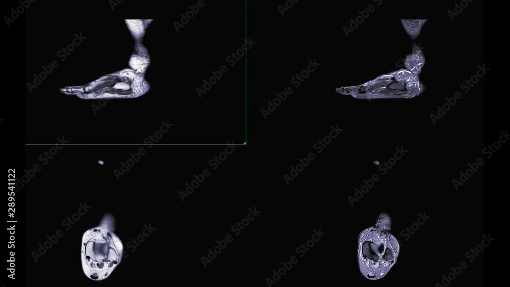 MRI FOOT compare Sagittal and axial T2 ,T1 for diagnostic tendon injury ...