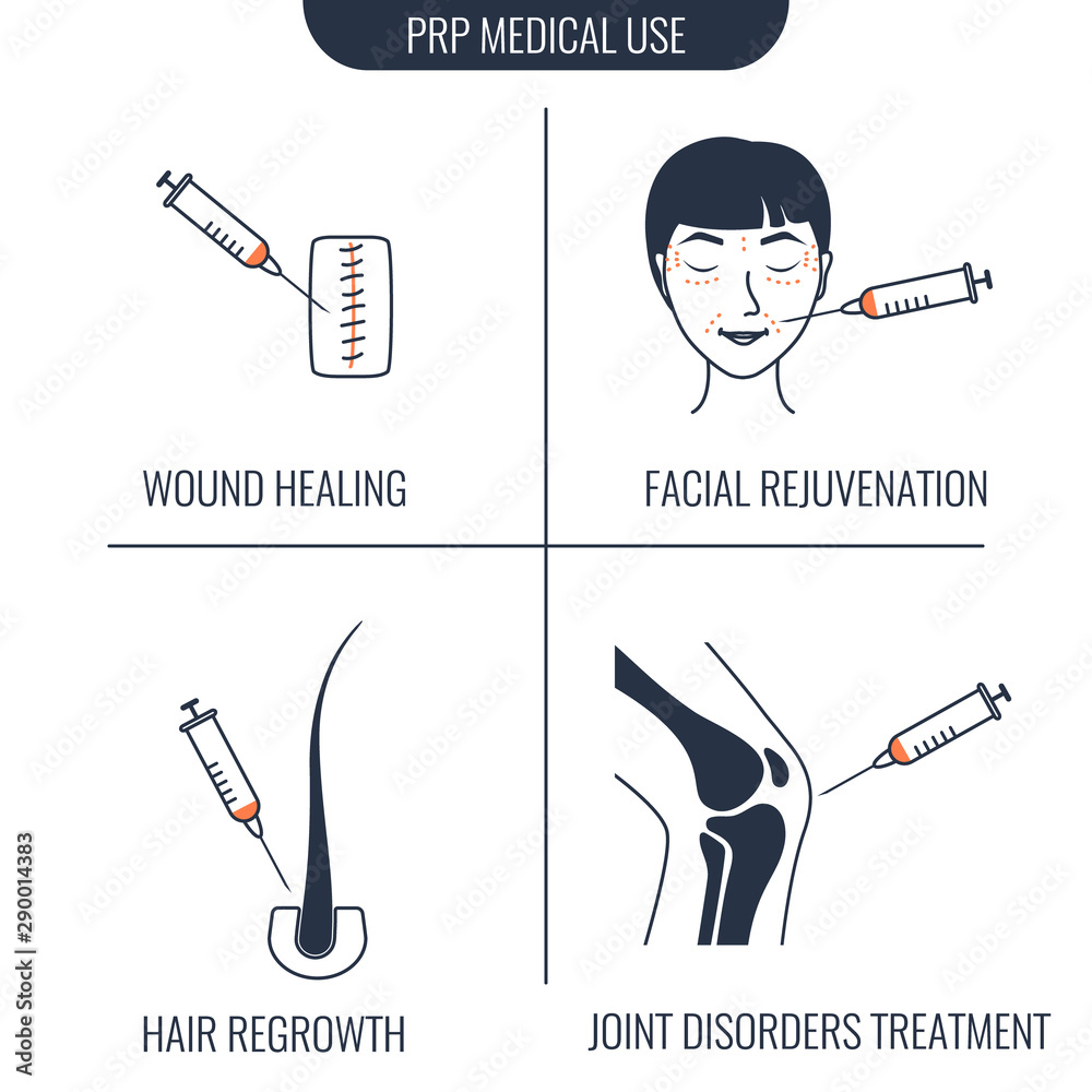 PRP medical use infographics vector set. Application of platelet-rich ...