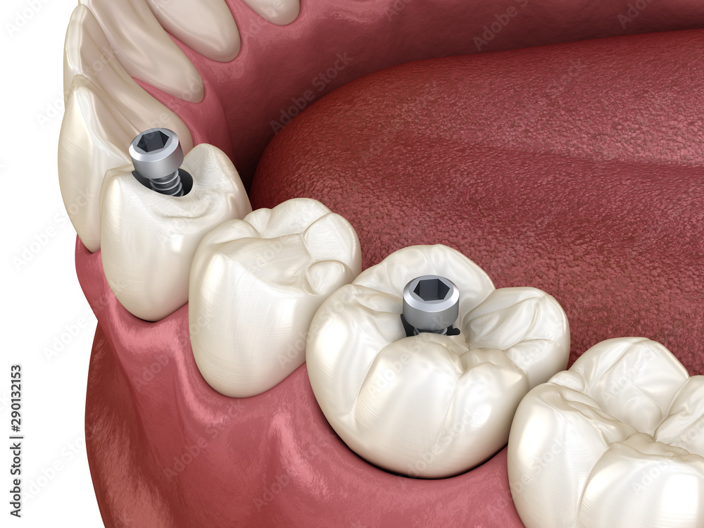 Premolar and Molar tooth crown installation over implant, screw ...
