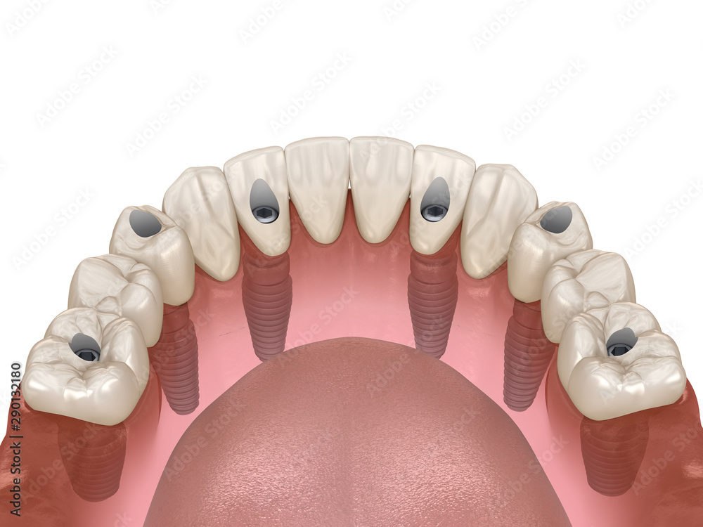 Mandibular prosthesis All on 4 system supported by implants, screw ...