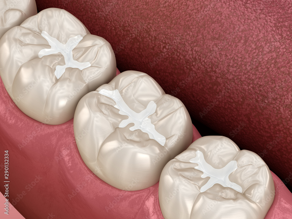 Molar Fissure dental fillings, Medically accurate 3D illustration of ...