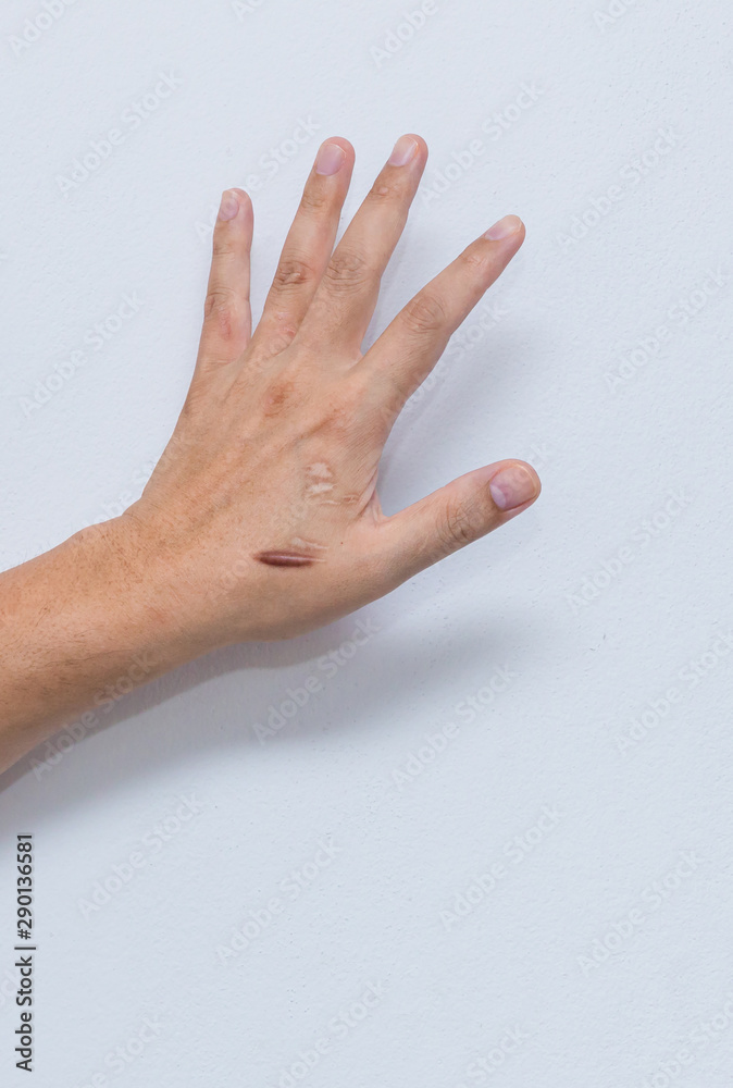 Keloid scar (Hypertrophic Scar) on man hand skin after accident ...