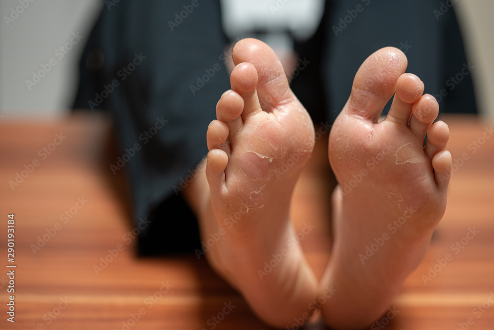 on a pair of feet the skin detaches due to eczema Stock Photo | Adobe Stock